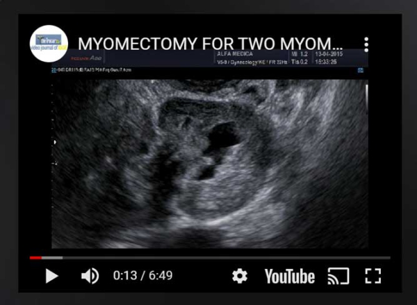 Hysterectomy – ISGE