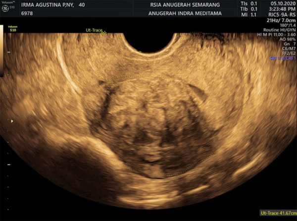 Laparoscopy Myomectomy For Submucous Fibroid In Patient With Previous
