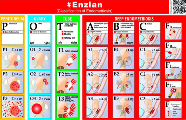 Enzian classification, a new description of endometriosis for invasive ...