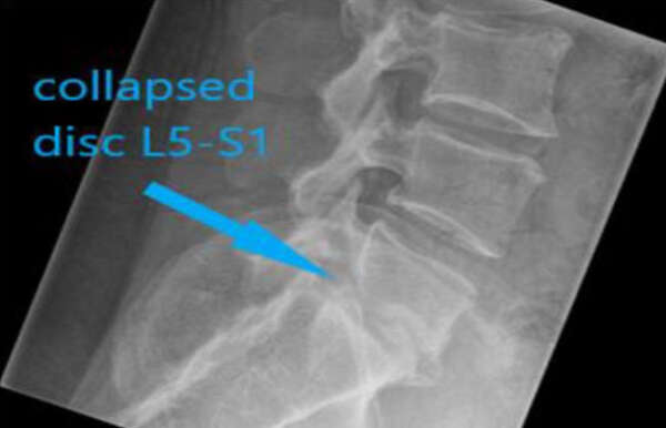 non-infectious discitis – ISGE
