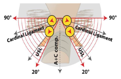 Enzian classification, a new description of endometriosis for invasive ...