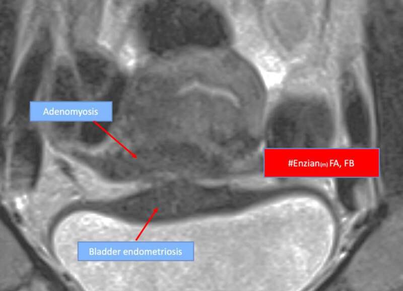 Enzian classification, a new description of endometriosis for invasive ...