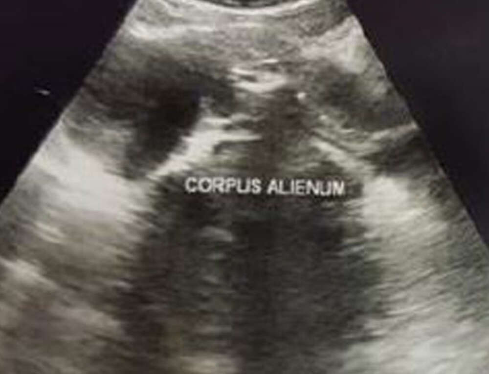 Enzian classification, a new description of endometriosis for invasive ...