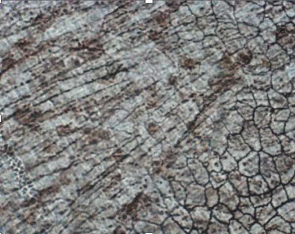 Adhesions: The Underestimated partner in Surgery: has there been ...