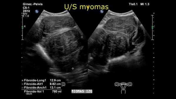 Hybrid v-NOTES: Laparoscopic-Assisted vaginal Natural Orifice ...
