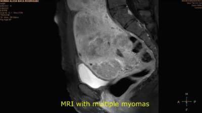 Hybrid v-NOTES: Laparoscopic-Assisted vaginal Natural Orifice ...
