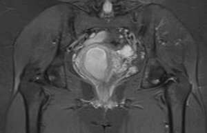 ISGE – The International Society for Gynecologic Endoscopy