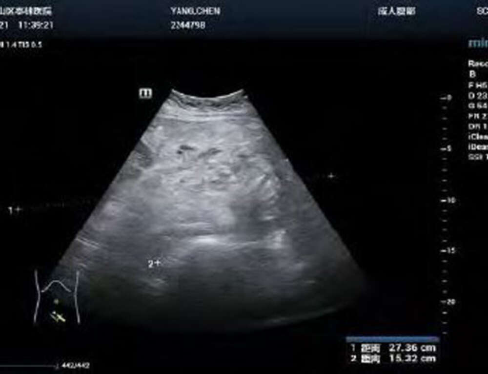 vNOTES hysterectomy technique in a case with big broad ligament fibroid ...