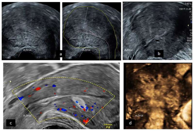 Diagnostic hysteroscopy: an atlas-like review of the endometrium from ...