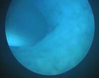 Fallopian tubes at diagnostic hysteroscopy – ISGE