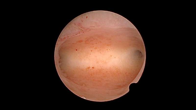 Diagnostic hysteroscopy for congenital anomalies of the female genital ...