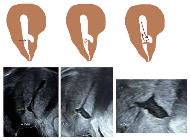 Isthmocele: new insights and review – ISGE
