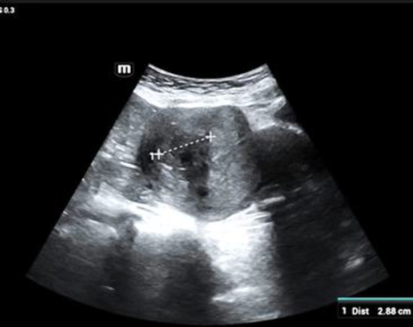 Laparoscopic hysterectomy with ventro-fixed uterus in a patient with ...