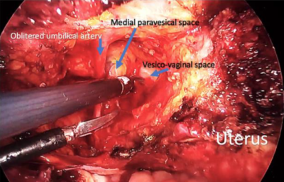 Laparoscopic hysterectomy with ventro-fixed uterus in a patient with ...