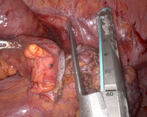 The Role of Robotic Surgery in Gynecology: Advancing Precision and ...