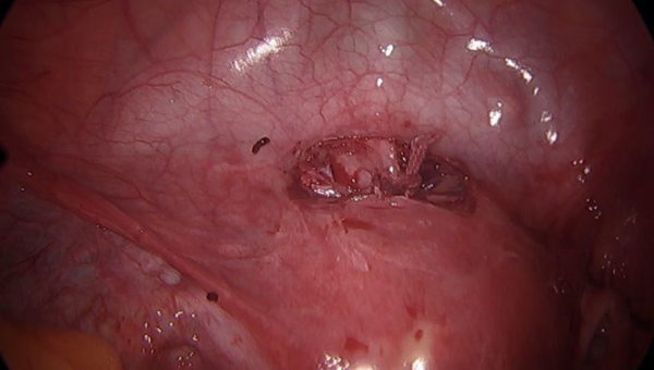 Trans abdominal cerclage for cervical incompetence: a simplified ...