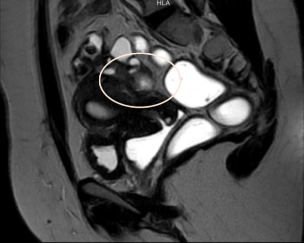 Parametrectomy and discoid resection for deep endometriosis of the ...
