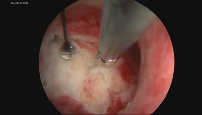 A Novel Hysteroscopic Approach for FIGO Type 2 Submucosal Leiomyomas ...